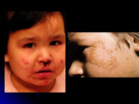 Common Pediatrics Infectious Diseases Dr Owis Khater