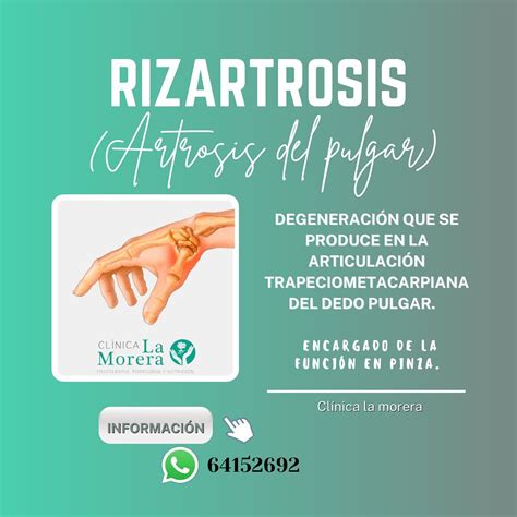 La Rizartrosis O Artrosis Del Pulgar Es Una Degeneración Que Tiene Lugar En La Articulación