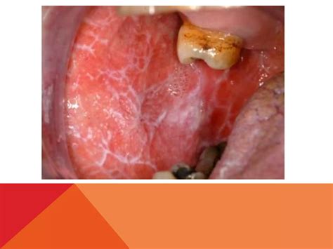 Oral Lichen Planus Pptx