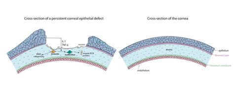 Depiction Of A Persistent Epithelial Defect Ped Note That In The Download Scientific Diagram