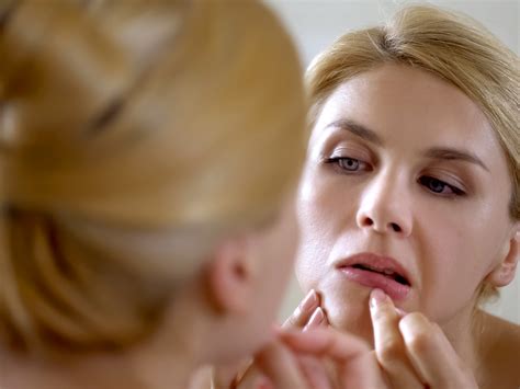 How ToGet Rid Of Pimple Redness Top Dermatologists 6 Simple Tips