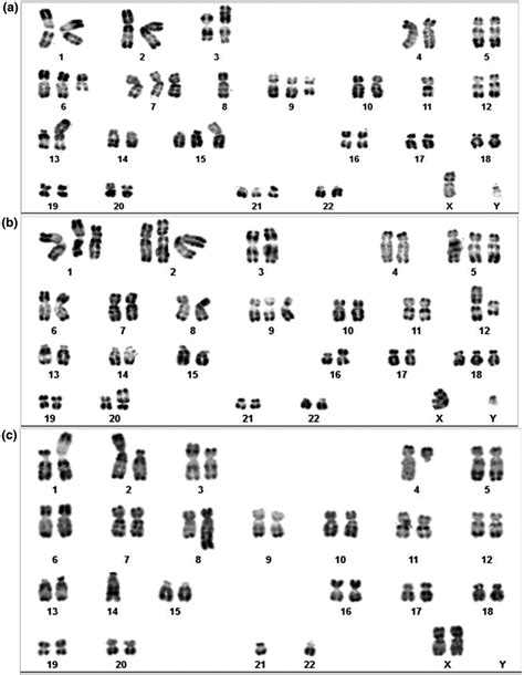 Abnormal Bone Marrow Karyotypes Examples A Karyotype Of Male With