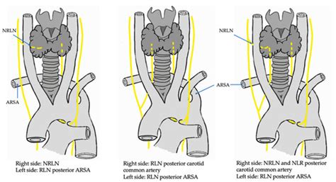 Systematic Review And Meta Analysis Recurrent Laryngeal Nerve Variants
