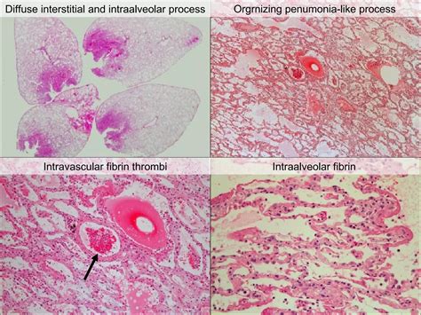 Diffuse Alveolar Damage Ppt