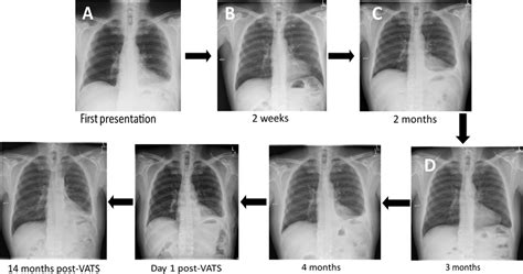Serial Chest X Rays Cxrs Of Patient 1 A First Presentation With