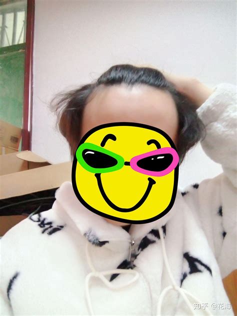 发际线高 整个人都不好了，求解 知乎