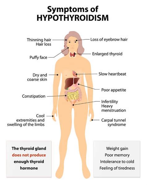 Hypothyroidism Symptoms And Treatment