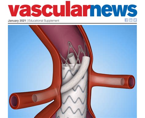 Chevar Technique Essentials A Practical Guide To Chimney Endovascular
