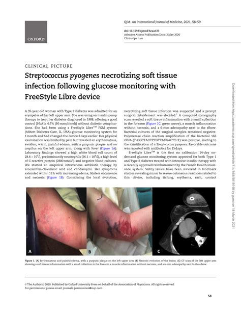 Pdf Streptococcus Pyogenes Necrotizing Soft Tissue Infection Following Glucose Monitoring With