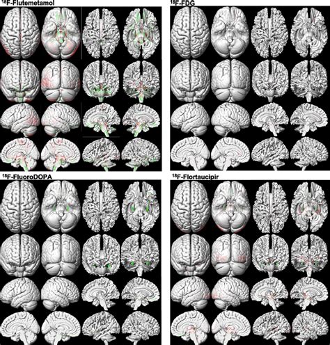 3d Rendered Views Of Voxel Wise Analysis Of Dl Predicted Pvc Images
