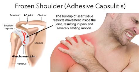 Frozen Shoulder Adhesive Capsulitis
