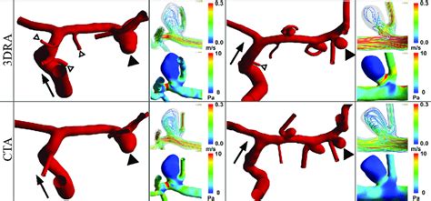 Two Patient Specific Vascular Models Extracted From 3dra And Cta Flow Download Scientific