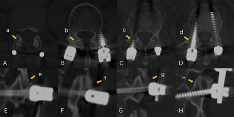 Proximal Facet Joint Violation In Accordance With The Babu Scale In Download Scientific Diagram