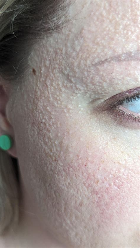 Bumpy Skin Developing Over Past 2~ Years 6mo Wait To See Derm R 30plusskincare