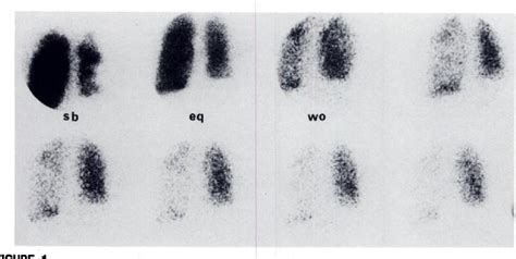 Figure 1 From Ventilation Perfusion Scan In The Acutely Ill Patient With Unilateral Hyperlucent