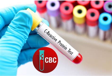 Increased Diagnostic Efficiency By Combining Part Differentiation And C Reactive Protein