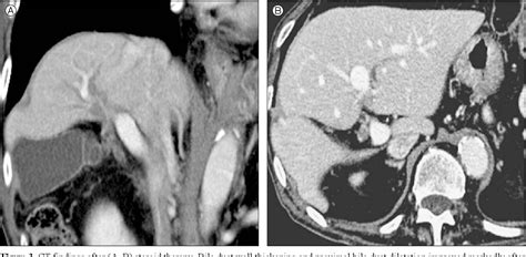 Figure 3 From A Case Of Igg4 Related Sclerosing Cholangitis With A 6