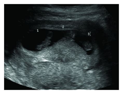 The Monozygotic Monochorionic Triamniotic Triplets In The 7th Week