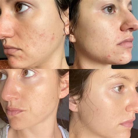 Jan 2020 To Today Retin A 025 Rtretinoin