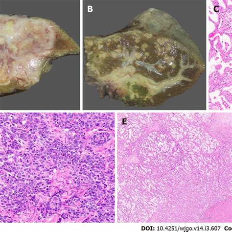 Gross Features And Morphology Of Cholangiocarcinoma A Mass Forming