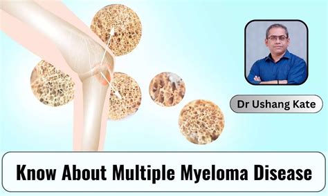 Multiple Myeloma A Comprehensive Guide To The Disease Dr Ushang Kate