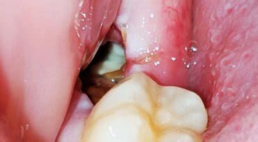 Normal Socket After Tooth Extraction With Pictures Go Fix Teeth