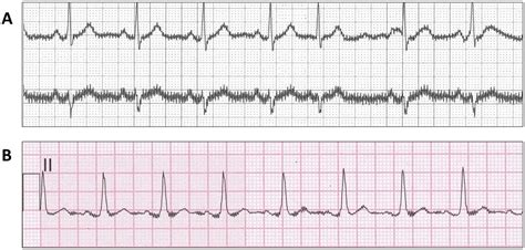 The Footprints Of Electrocardiographic Interference Fact Or Artefact