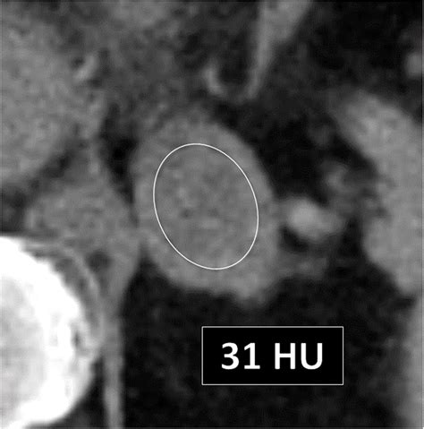 Adrenal Adenomas Versus Metastases Diagnostic Performance Of Dual Energy Spectral Ct Virtual