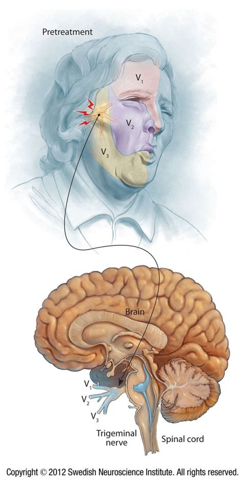 Trigeminal Neuralgia Comparison Of Treatment Methods SeattleNeurosciences Com