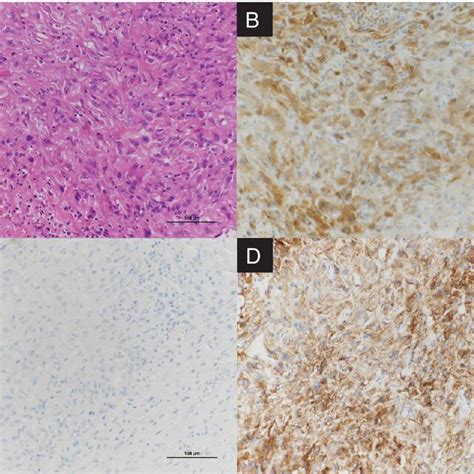 Sarcomatoid Malignant Pleural Mesothelioma Detected By Percutaneous