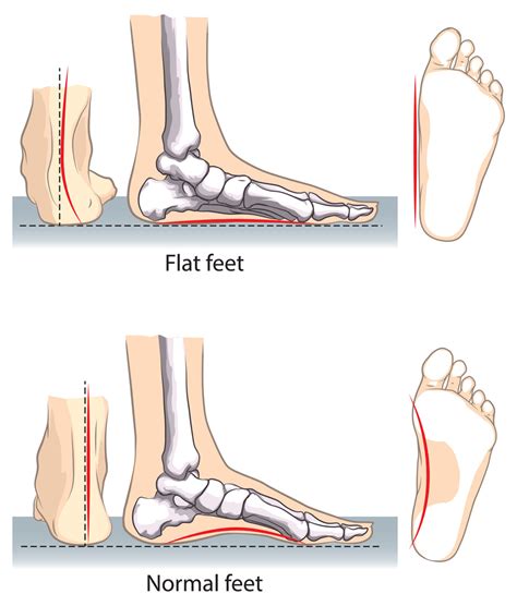 Foot Alignment And Orthotics Pedicurian