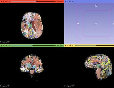 Tutorial Segmenting Your Brain In Mri — No Installation Just Containers By Mithilesh Medium