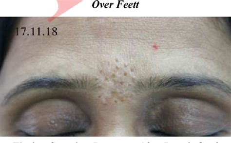 Figure 2 From A Case Of Chemical Leukoderma Effectively Treated With