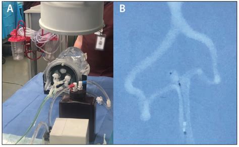 Update On Current And Future Intrasaccular Flow Disruptors Endovascular Today