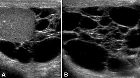 Gamut Of Extratesticular Scrotal Masses Anatomic Approach To