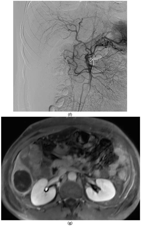 Selective Arterial Embolization Of Ruptured Hepatocellular Carcinoma With N Butyl Cyanoacrylate