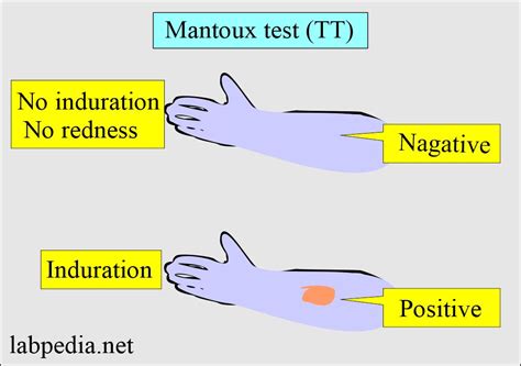 Ppd Skin Test Tuberculosis Test Vrogue Co