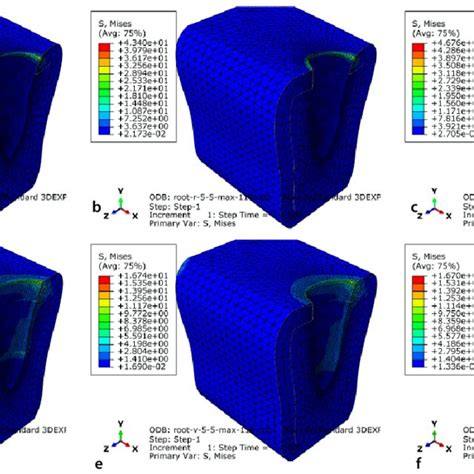 The Von Mises Stress Distributions Of The Alveolar Bone In Different