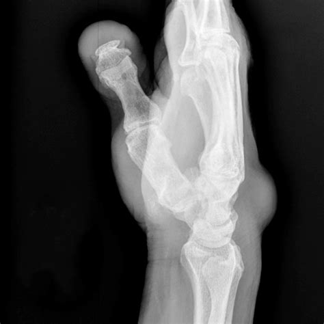 Stenosing Tenosynovitis Of The 4th Extensor Compartment Radsource