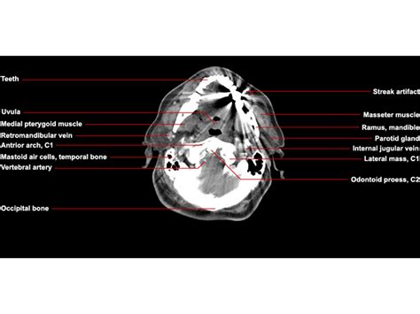 Ct Neck Axial Anatomy Radiologypicscom