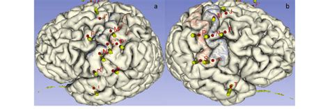 3d Schema Of Stereo Eeg Electrode Implantation Demonstrating The Left Download Scientific