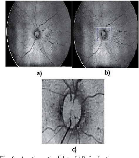 Figure 8 From Optical Nerve Segmentation Using The Active Shape Method Semantic Scholar