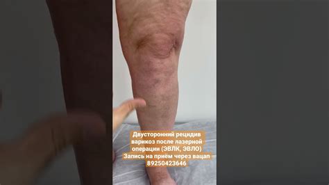 Варикоз двусторонний рецидив после лазера. Сосудистый хирург Москва ...