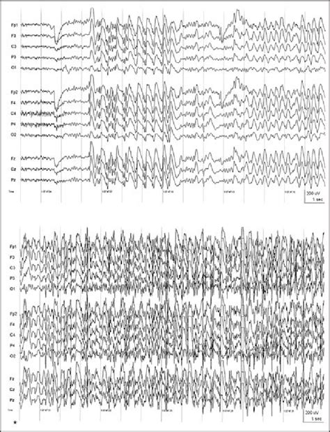 Patient Jl Ictal Eeg Onset Of The Seizure In Videosequence 1