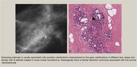 References In Benign Microcalcification And Its Differential Diagnosis