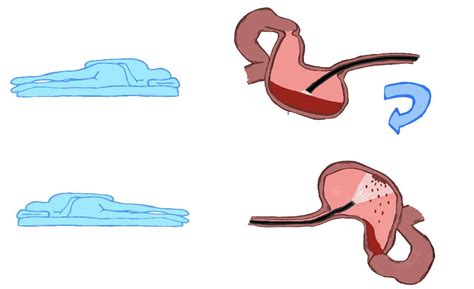 Patient Position In Operative Endoscopy Italian Society For Surgical Endoscopy Società