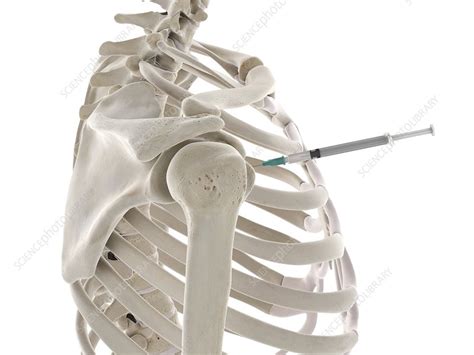 Shoulder Injection Illustration Stock Image F0294555 Science