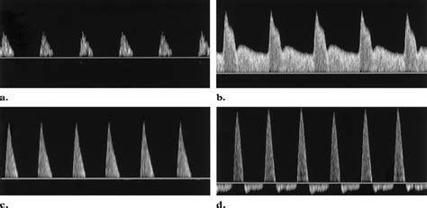 Normal Doppler Waveform Changes In The Cavernosal Arteries During The Download Scientific