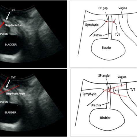 Dislocated Tension Free Vaginal Tape Correctly Placed Second Download Scientific Diagram
