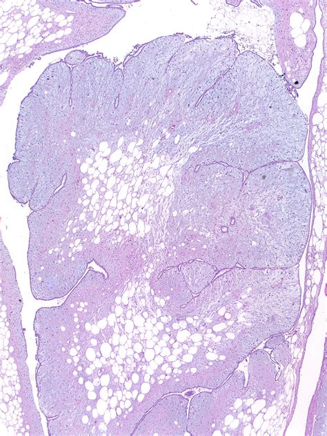 Phyllodes Tumor Mgh Learn Pathology